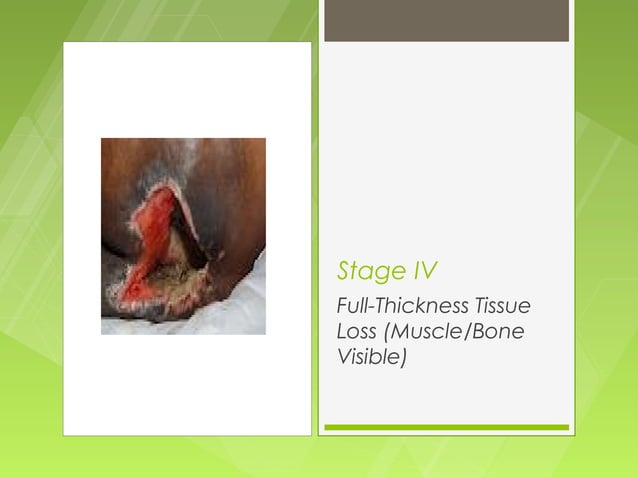 Skin integrity and Wound Care | PPT | Skin and Dermatology | Diseases ...