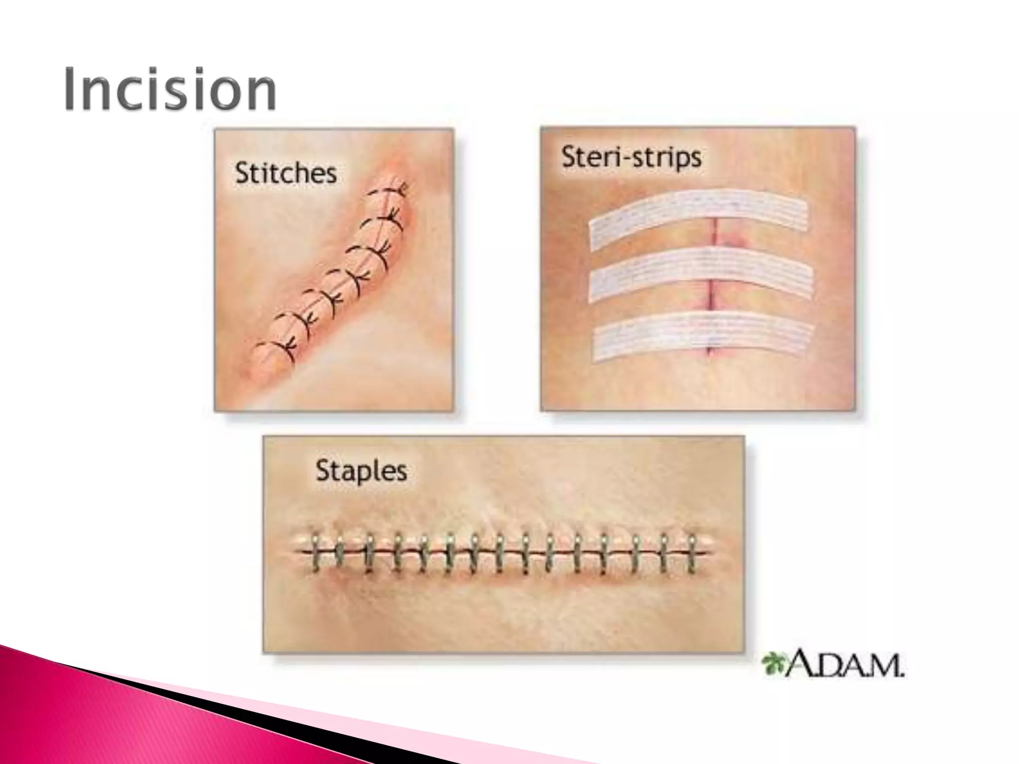 Skin Integrity and Wound Healingstudentvers.pptx