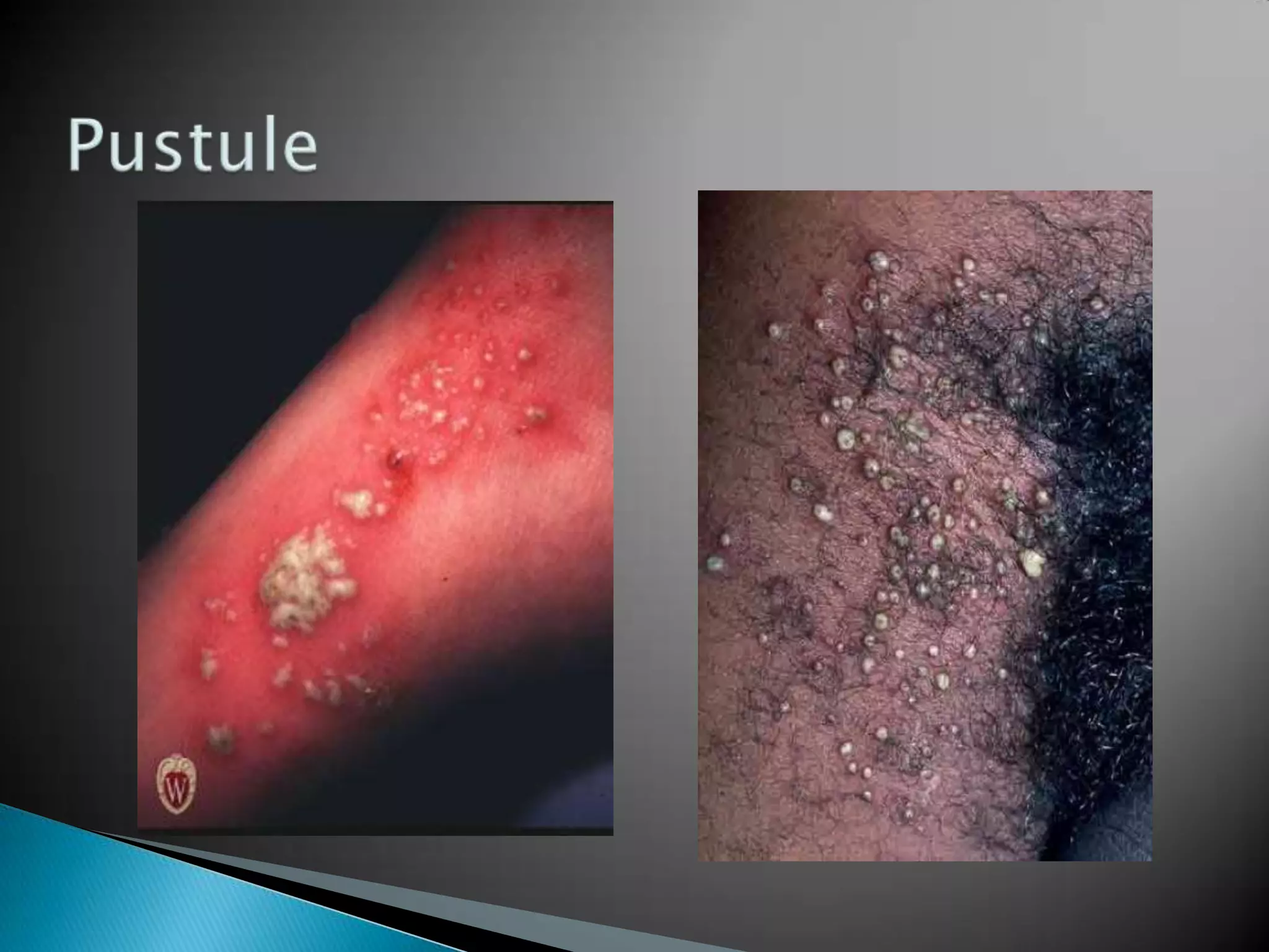 Skin lesions | PPT