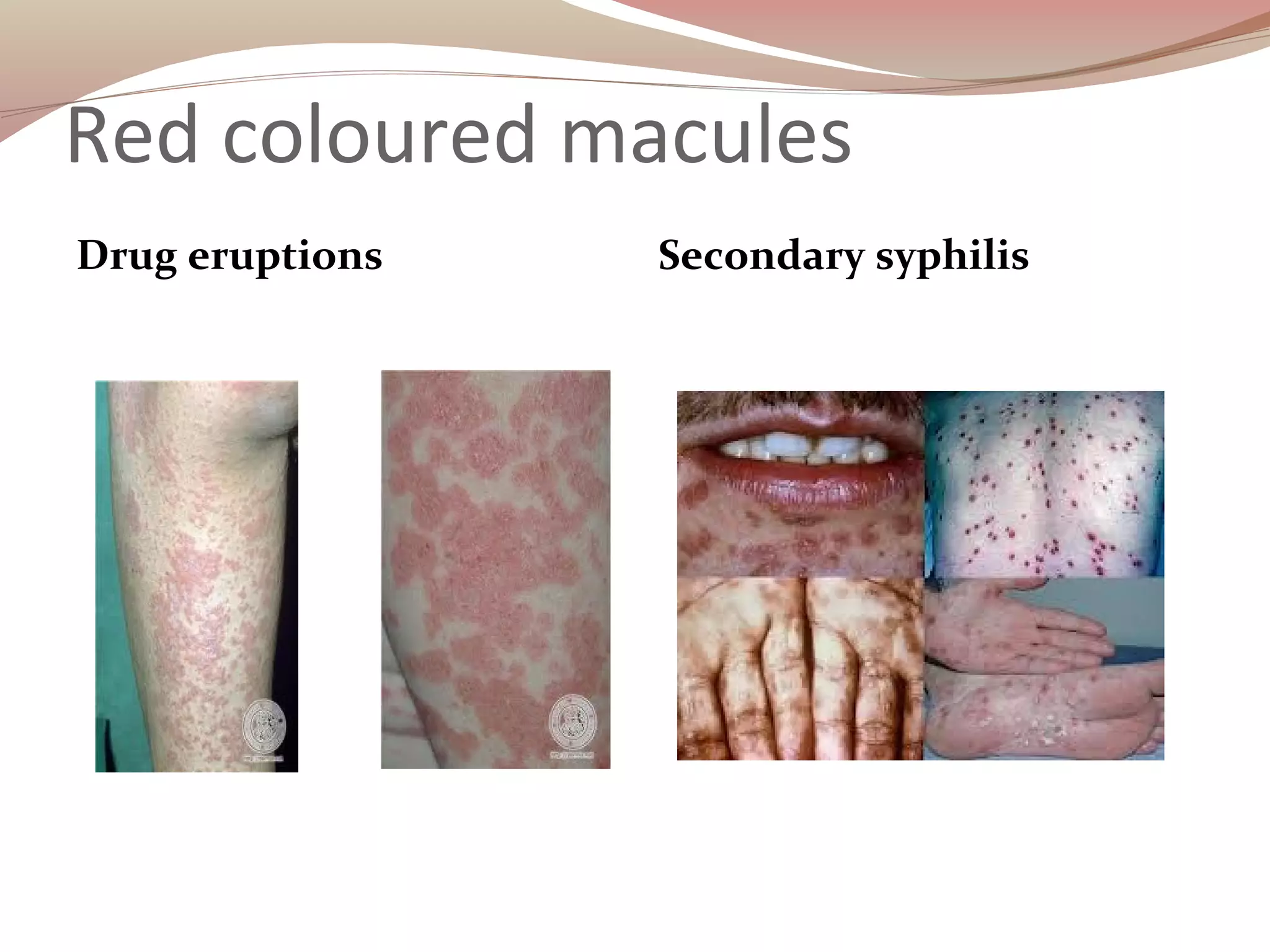 Skin lesions | PPT