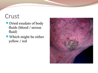 Skin lesions | PPT