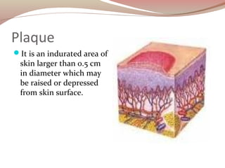 Papule Plaque