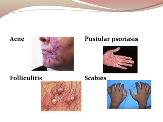 Pustule Skin Lesion