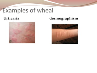 Wheal Skin Lesion