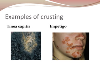 Crust Skin Lesion