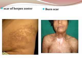 Tubercle Skin Lesion