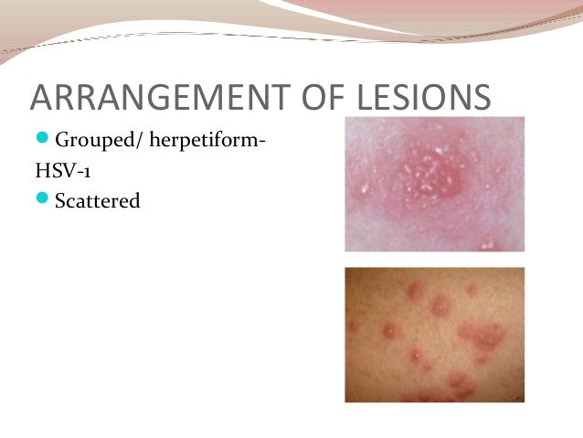 Skin lesions