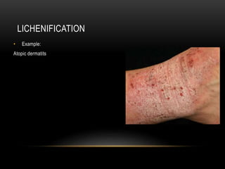 Skin lesions morphology.pptx