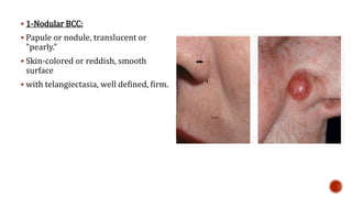 Different types of skin tumours and their management | PPTX