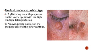 Different types of skin tumours and their management | PPTX