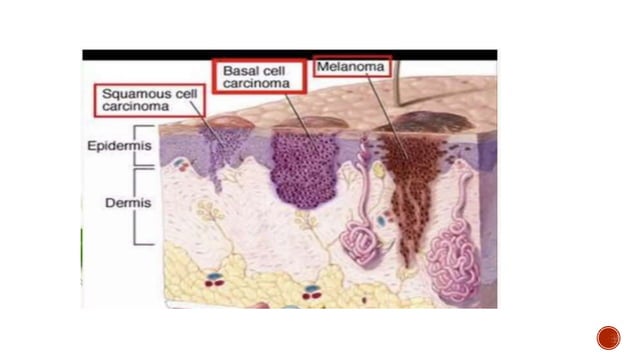 Different types of skin tumours and their management | PPT