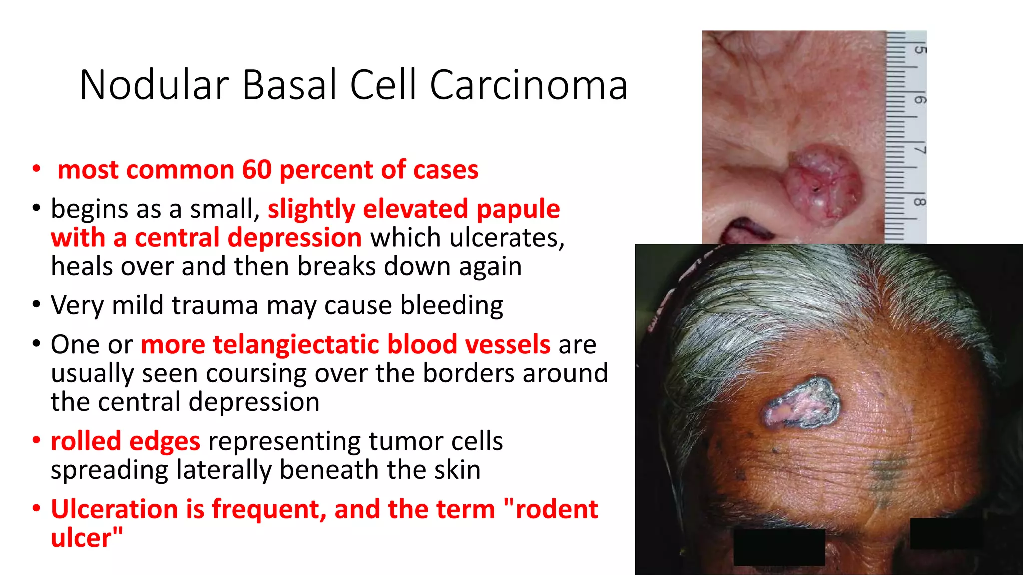 Skin malignancy md3 | PPTX