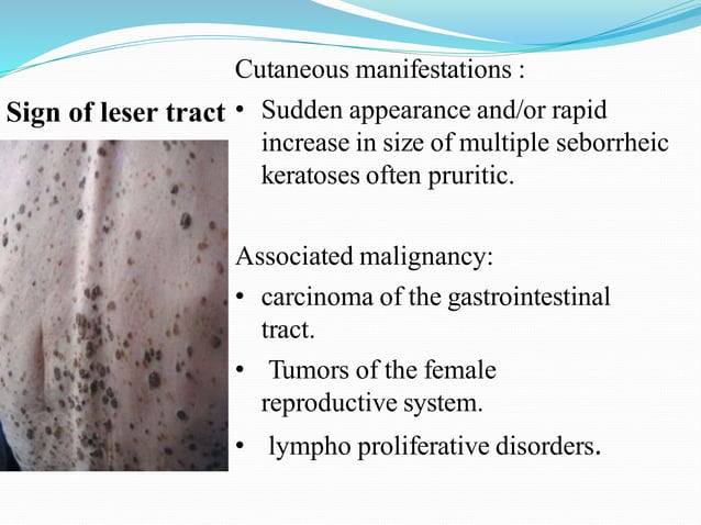 Skin manifestation of internal malignancy | PPTX | Skin and Dermatology ...
