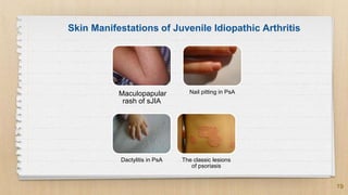 Skin manifestations in rheumatic diseases | PPTX | Skin and Dermatology ...