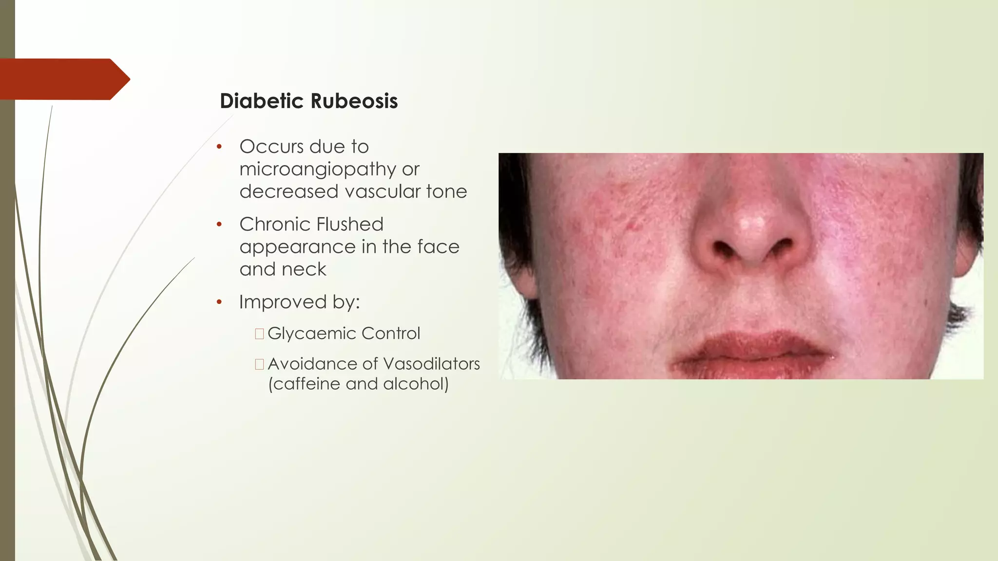 Skin Manifestation of Diabetes | PPTX