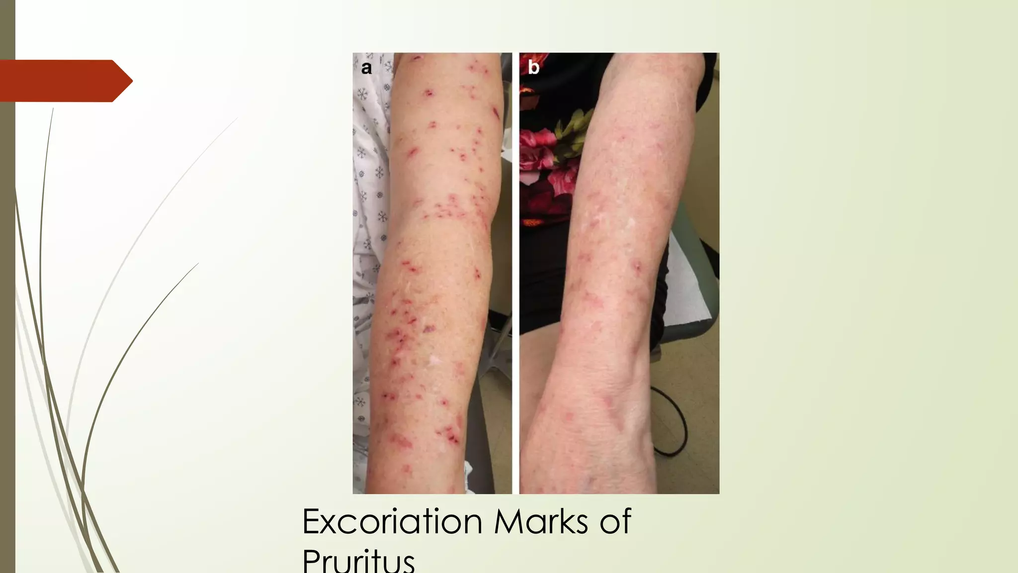 Skin Manifestation of Diabetes | PPTX
