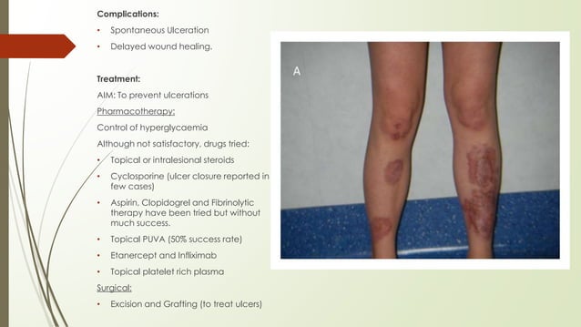 Skin Manifestation of Diabetes | PPTX