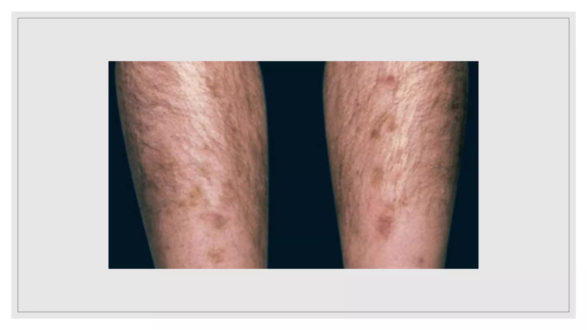 SKIN MANIFESTATIONS OF DIABETES MELLITUS.pptx