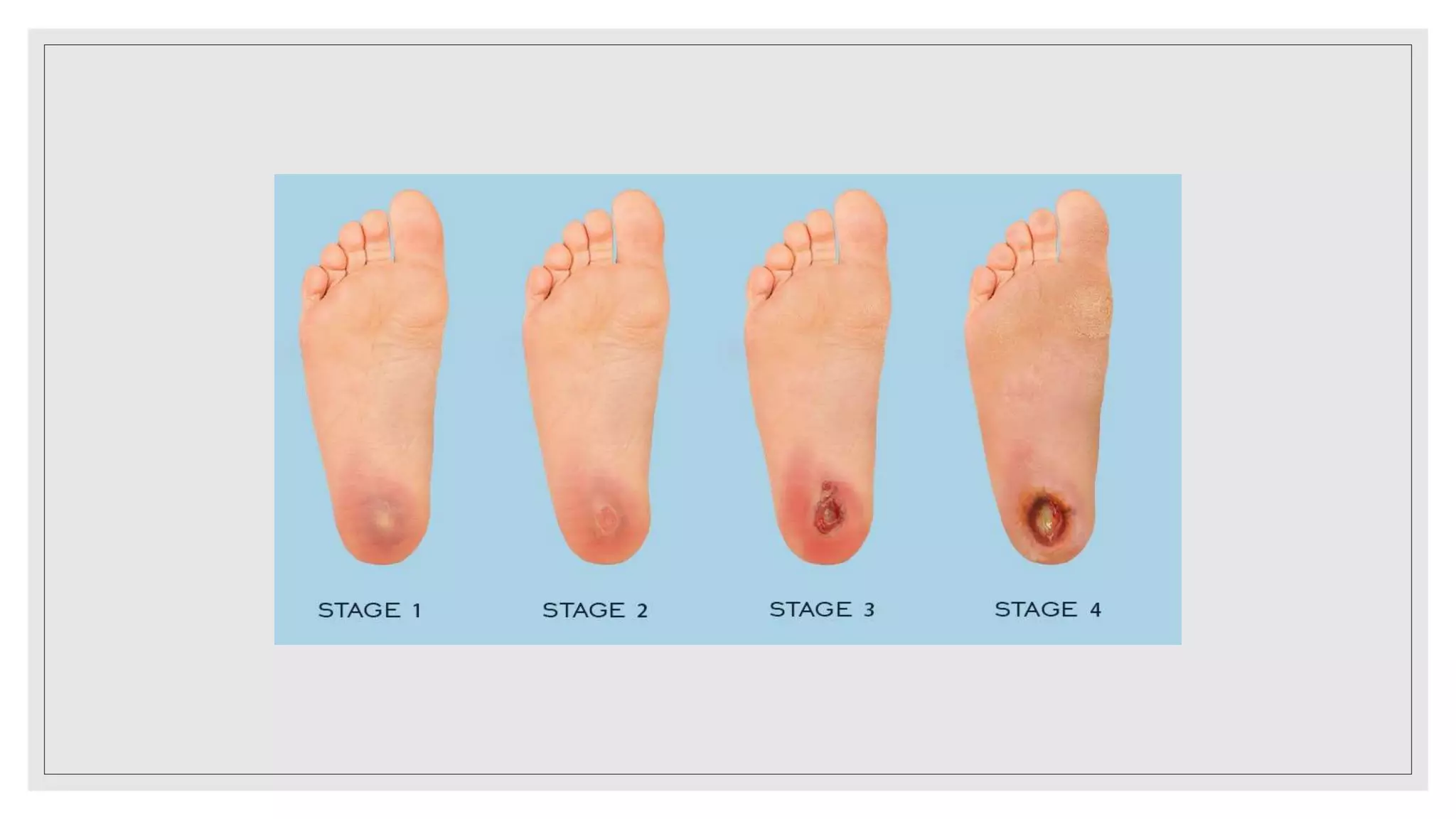 SKIN MANIFESTATIONS OF DIABETES MELLITUS.pptx