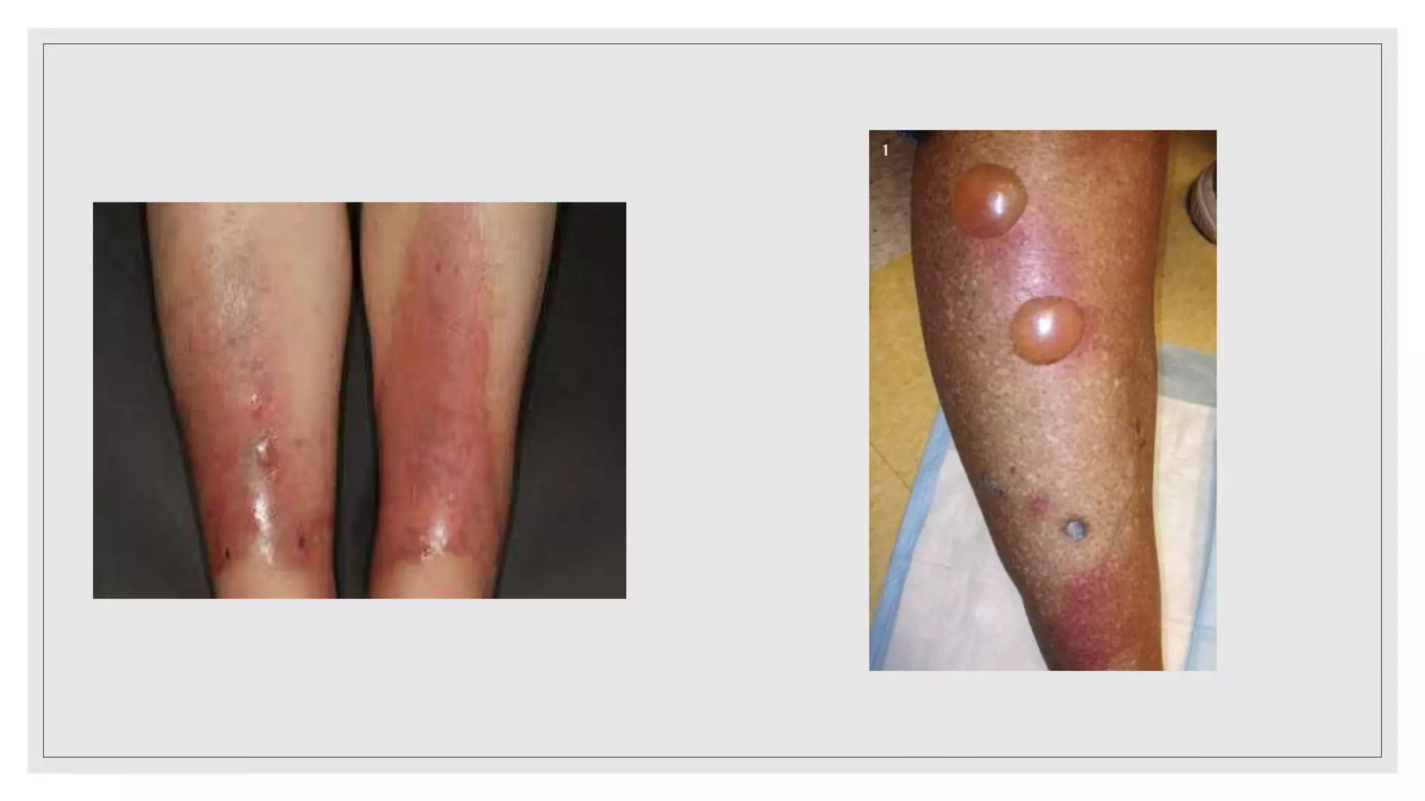 SKIN MANIFESTATIONS OF DIABETES MELLITUS.pptx