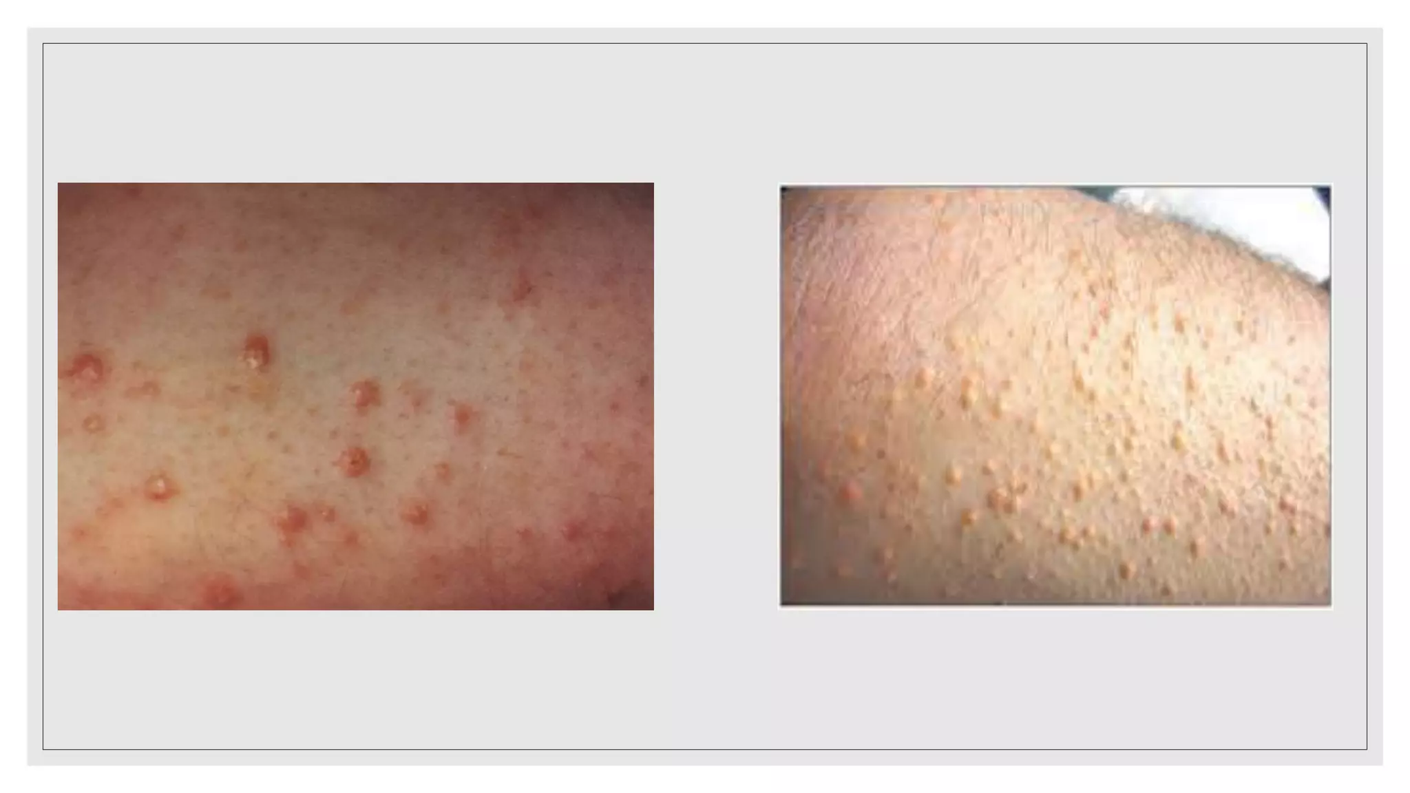 SKIN MANIFESTATIONS OF DIABETES MELLITUS.pptx