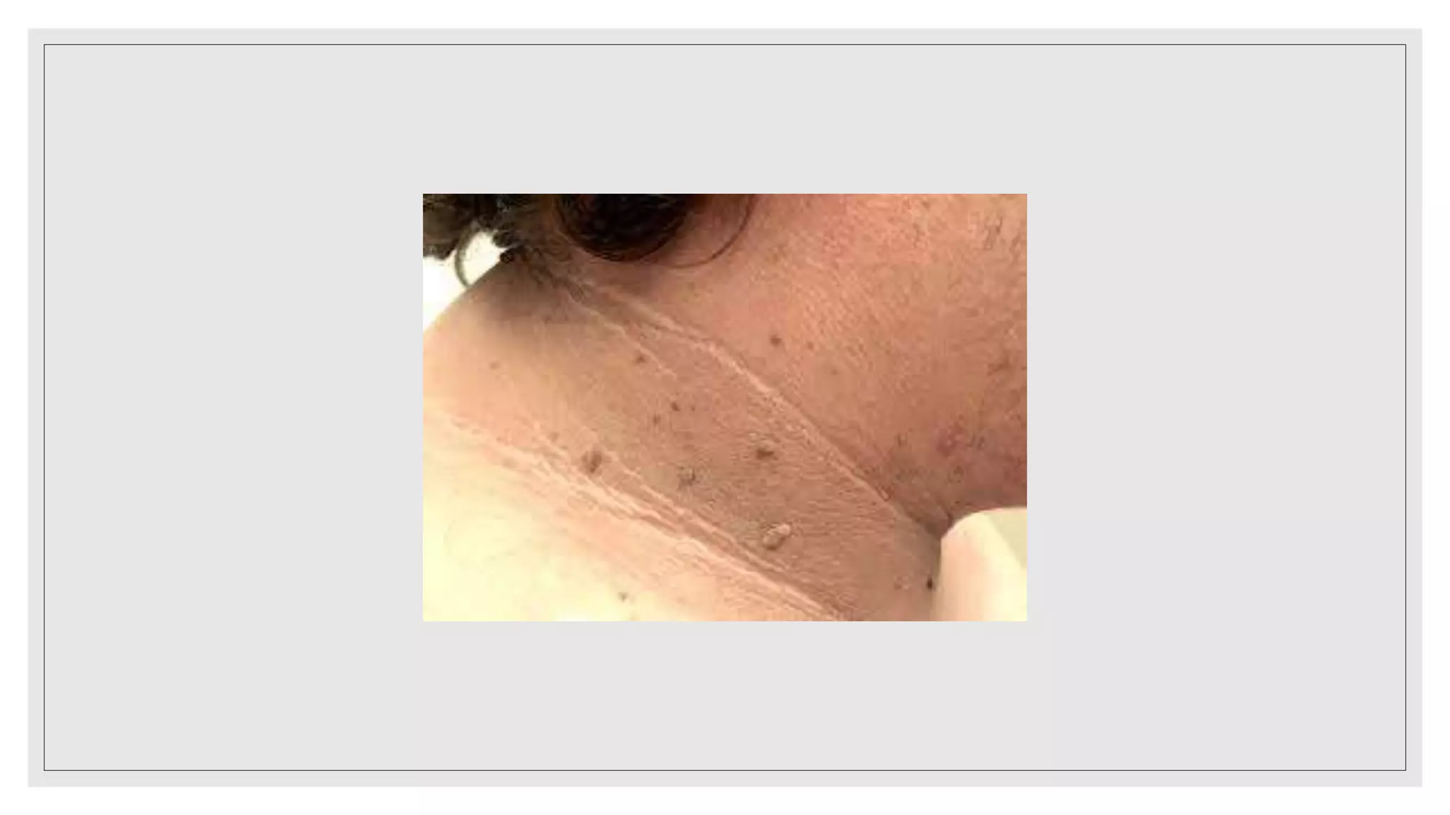 SKIN MANIFESTATIONS OF DIABETES MELLITUS.pptx