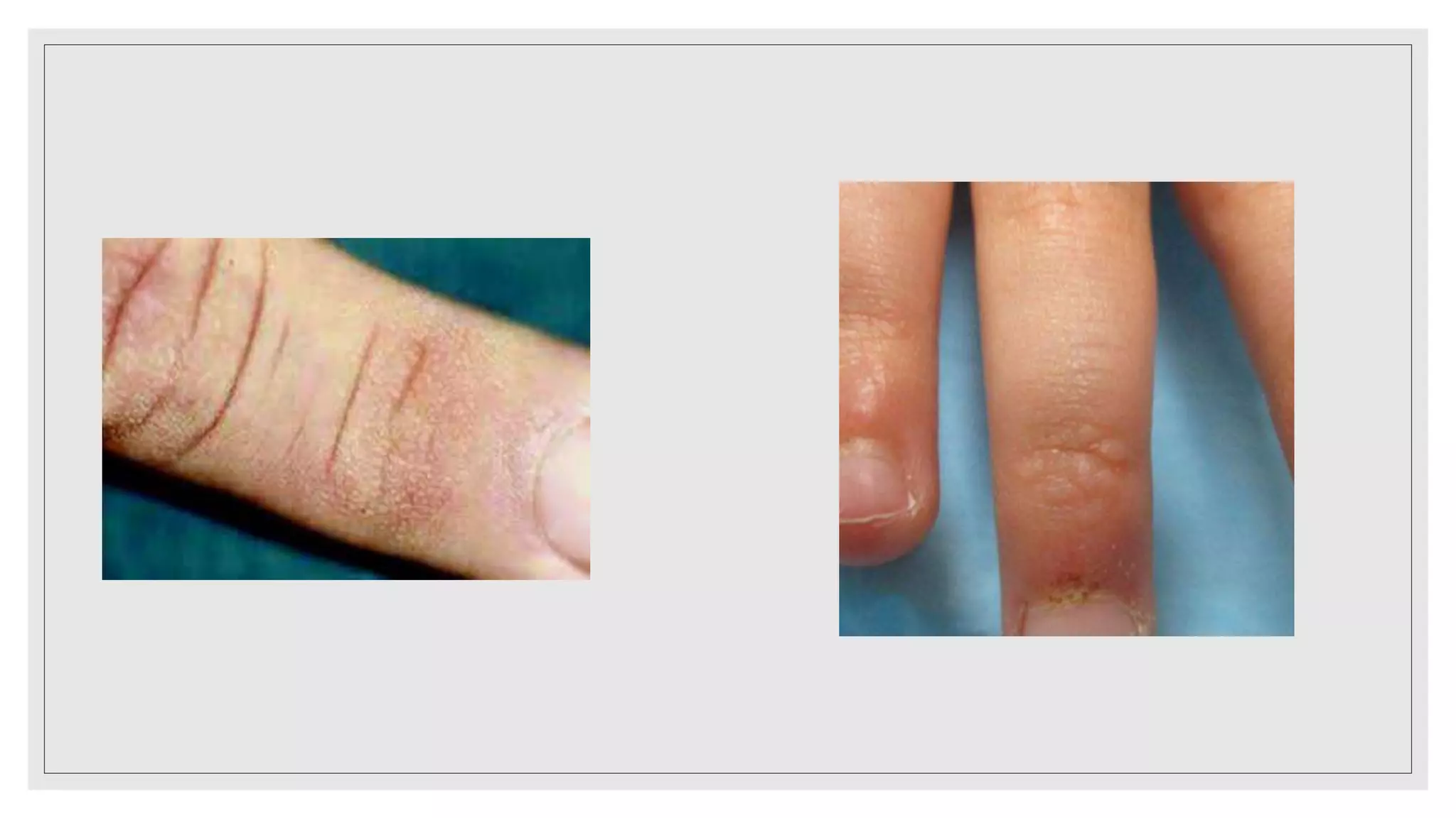 SKIN MANIFESTATIONS OF DIABETES MELLITUS.pptx