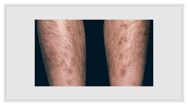 SKIN MANIFESTATIONS OF DIABETES MELLITUS.pptx
