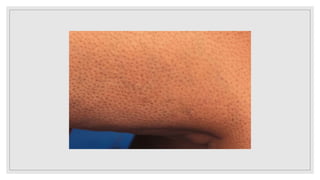 SKIN MANIFESTATIONS OF DIABETES MELLITUS.pptx