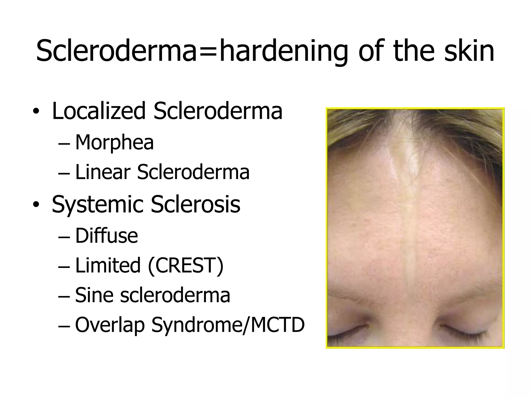 Skin Manifestations of Scleroderma, by Dr. Lorinda Chung MD | PPTX ...