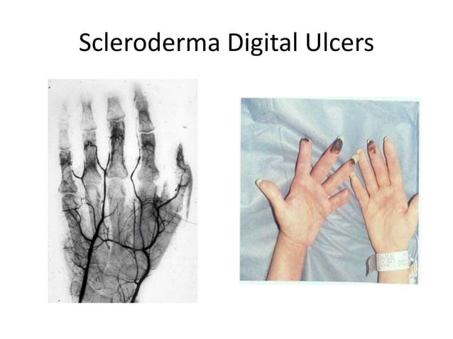 Skin Manifestations of Scleroderma, by Dr. Lorinda Chung MD | PPTX ...