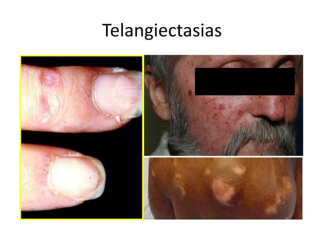 Skin Manifestations of Scleroderma, by Dr. Lorinda Chung MD | PPTX ...