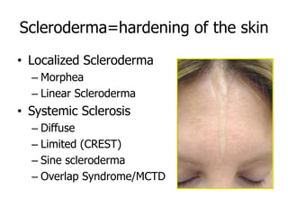 Skin Manifestations of Scleroderma, by Dr. Lorinda Chung MD | PPTX ...