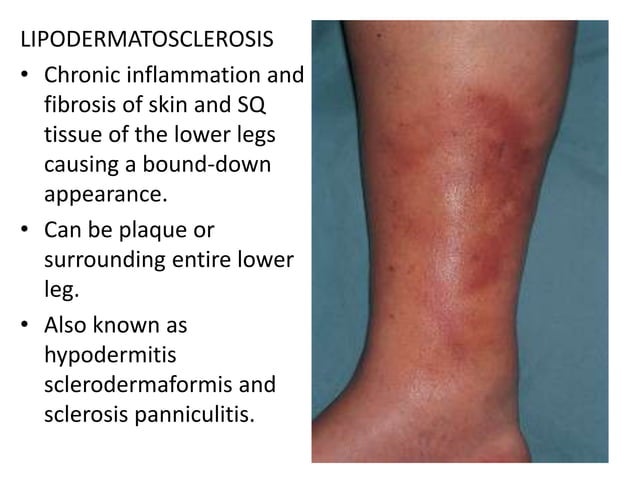 Skin Manifestations of Scleroderma, by Dr. Lorinda Chung MD | PPTX ...