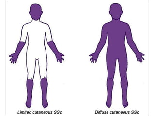 Skin Manifestations of Scleroderma, by Dr. Lorinda Chung MD | PPTX ...