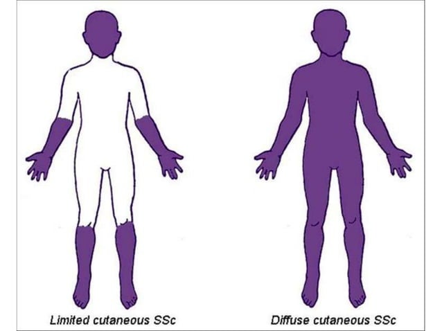 Skin Manifestations of Scleroderma, by Dr. Lorinda Chung MD | PPTX ...