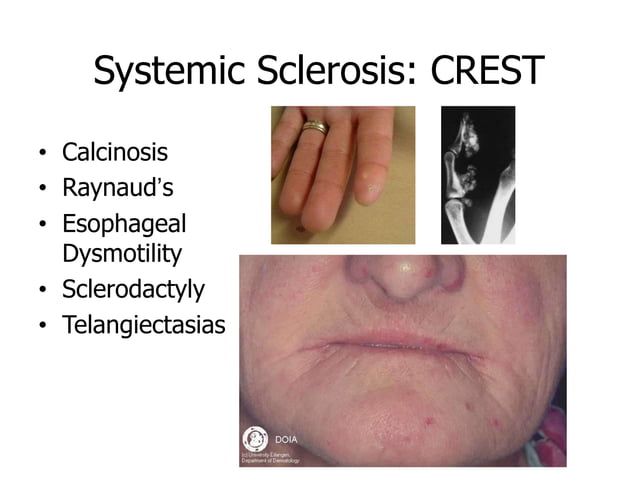 Skin Manifestations of Scleroderma, by Dr. Lorinda Chung MD | PPT