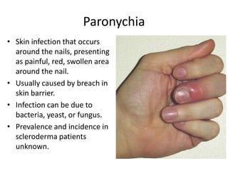 Skin Manifestations of Scleroderma, by Dr. Lorinda Chung MD | PPT
