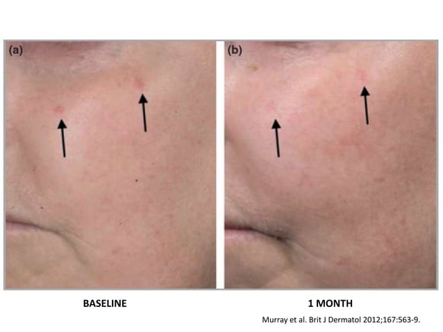 Skin Manifestations of Scleroderma, by Dr. Lorinda Chung MD