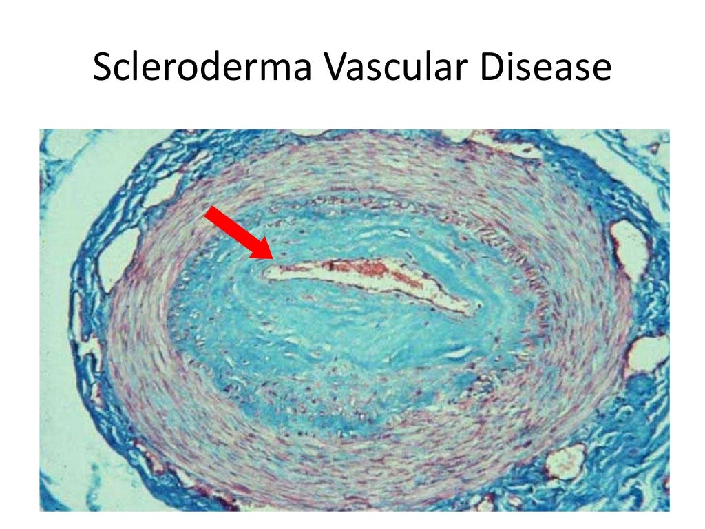 Skin Manifestations of Scleroderma, by Dr. Lorinda Chung MD