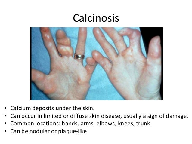 Skin Manifestations of Scleroderma, by Dr. Lorinda Chung MD