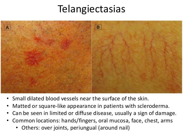 Crest Syndrome Rash