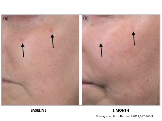 Skin Manifestations of Scleroderma, by Dr. Lorinda Chung MD