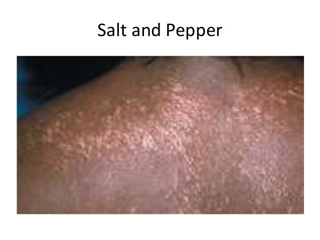 Skin Manifestations of Scleroderma, by Dr. Lorinda Chung MD