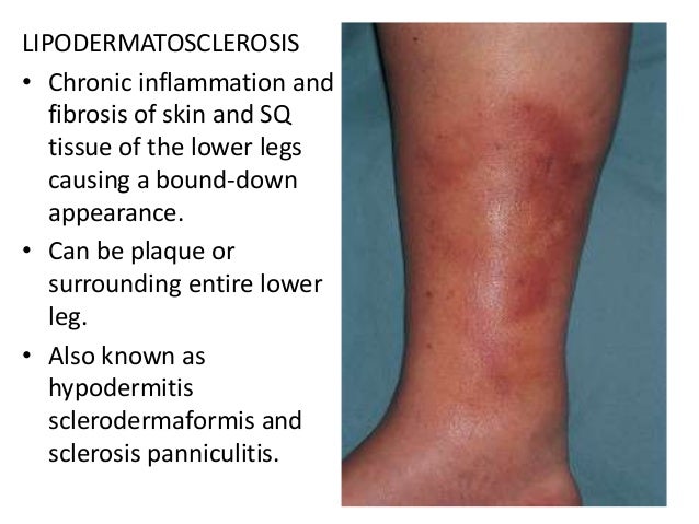 Skin Manifestations of Scleroderma, by Dr. Lorinda Chung MD