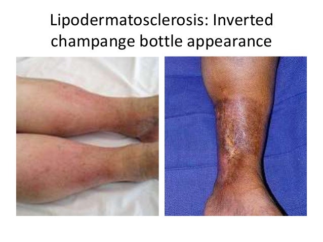 Skin Manifestations of Scleroderma, by Dr. Lorinda Chung MD