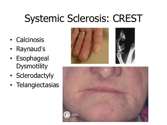 Skin Manifestations of Scleroderma, by Dr. Lorinda Chung MD