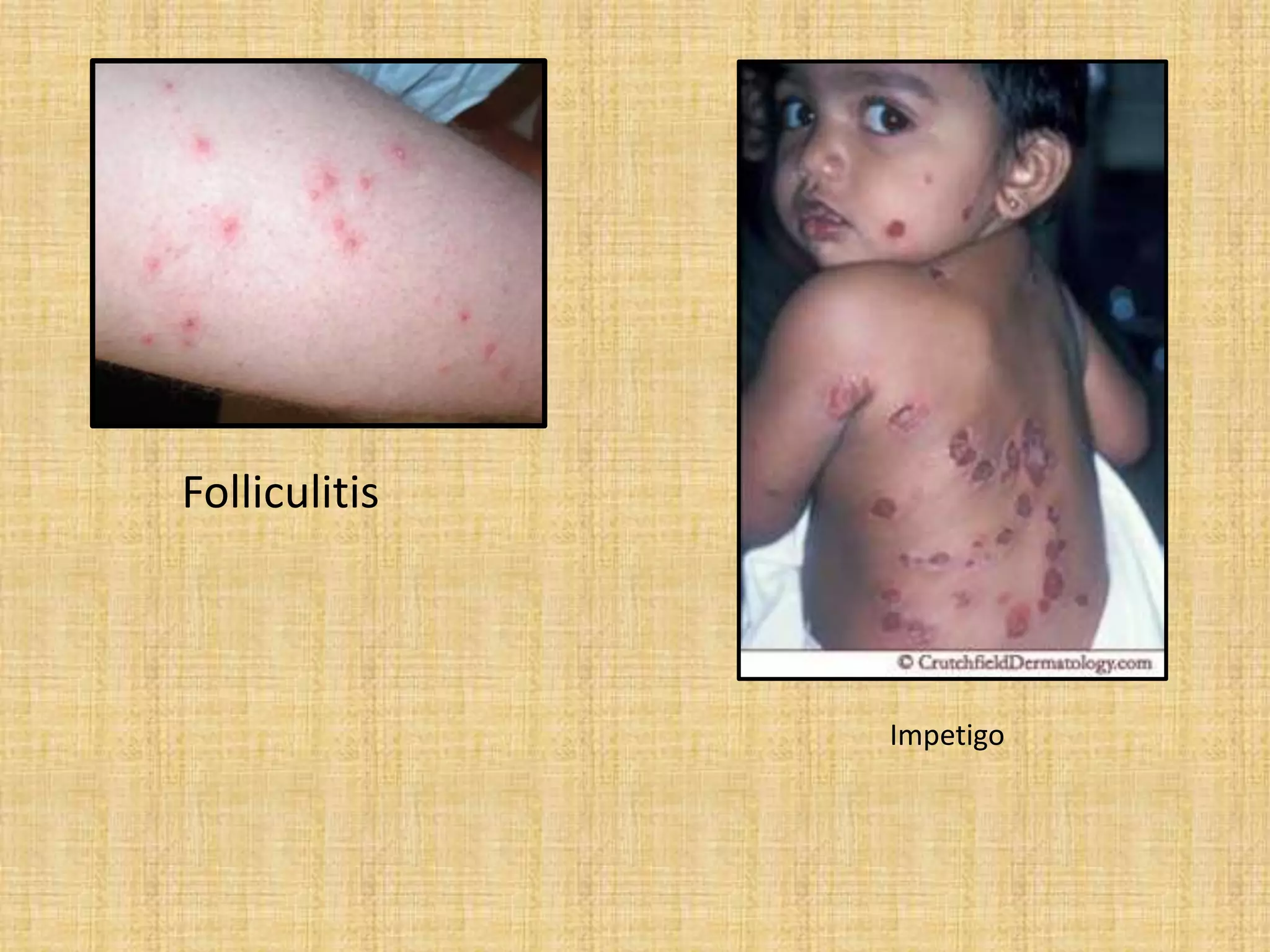 Skin microflora / Normal Flora of Skin | PPTX