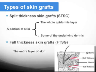 Skinn grafting1 | PPT