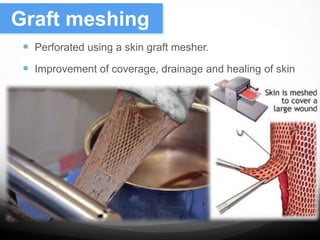 Skinn grafting1 | PPT